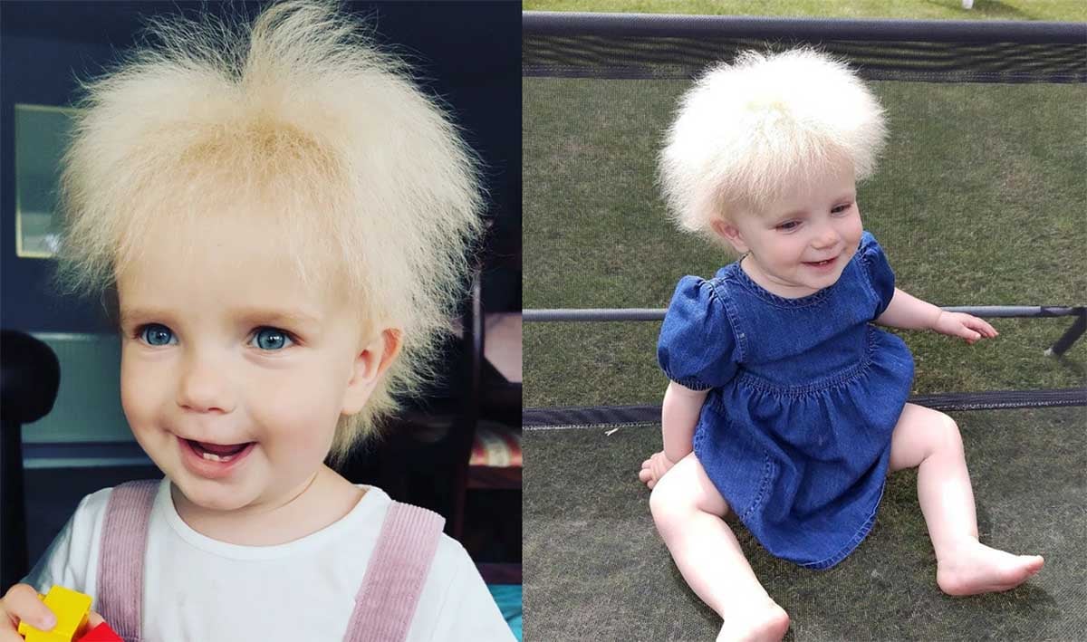 Niña con síndrome de cabello impeinable causa furor en redes | Bioguia